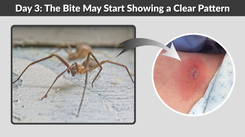 Brown Recluse Bite Stages: Day 1 to Day 7 Symptoms and Care